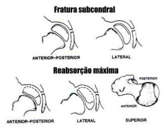 Epifisiólise - FisioWeb WGate - Referência em Fisioterapia na Internet.